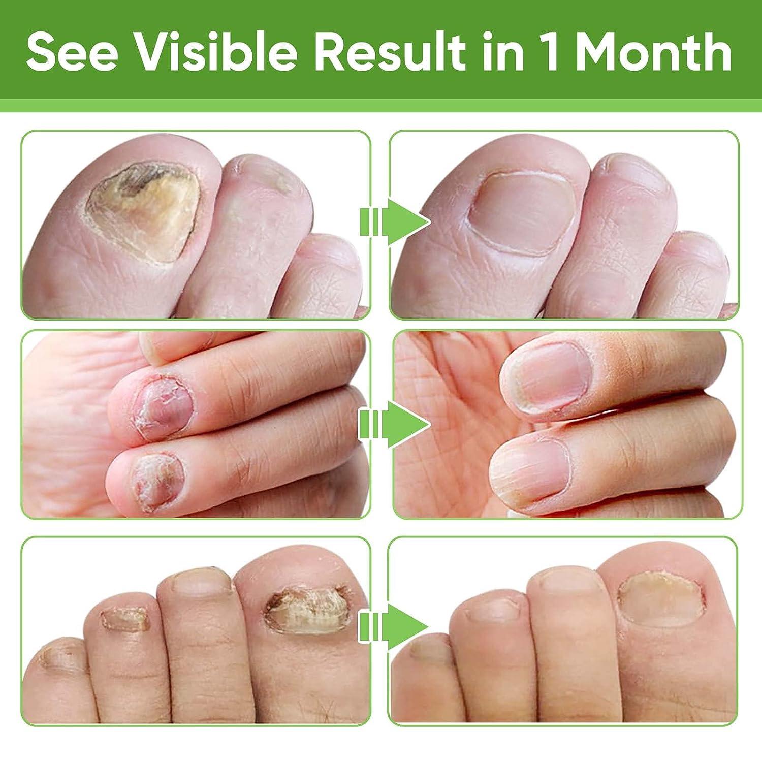 Tea Tree for Nail Fungus: My Experience & Guide Effectively